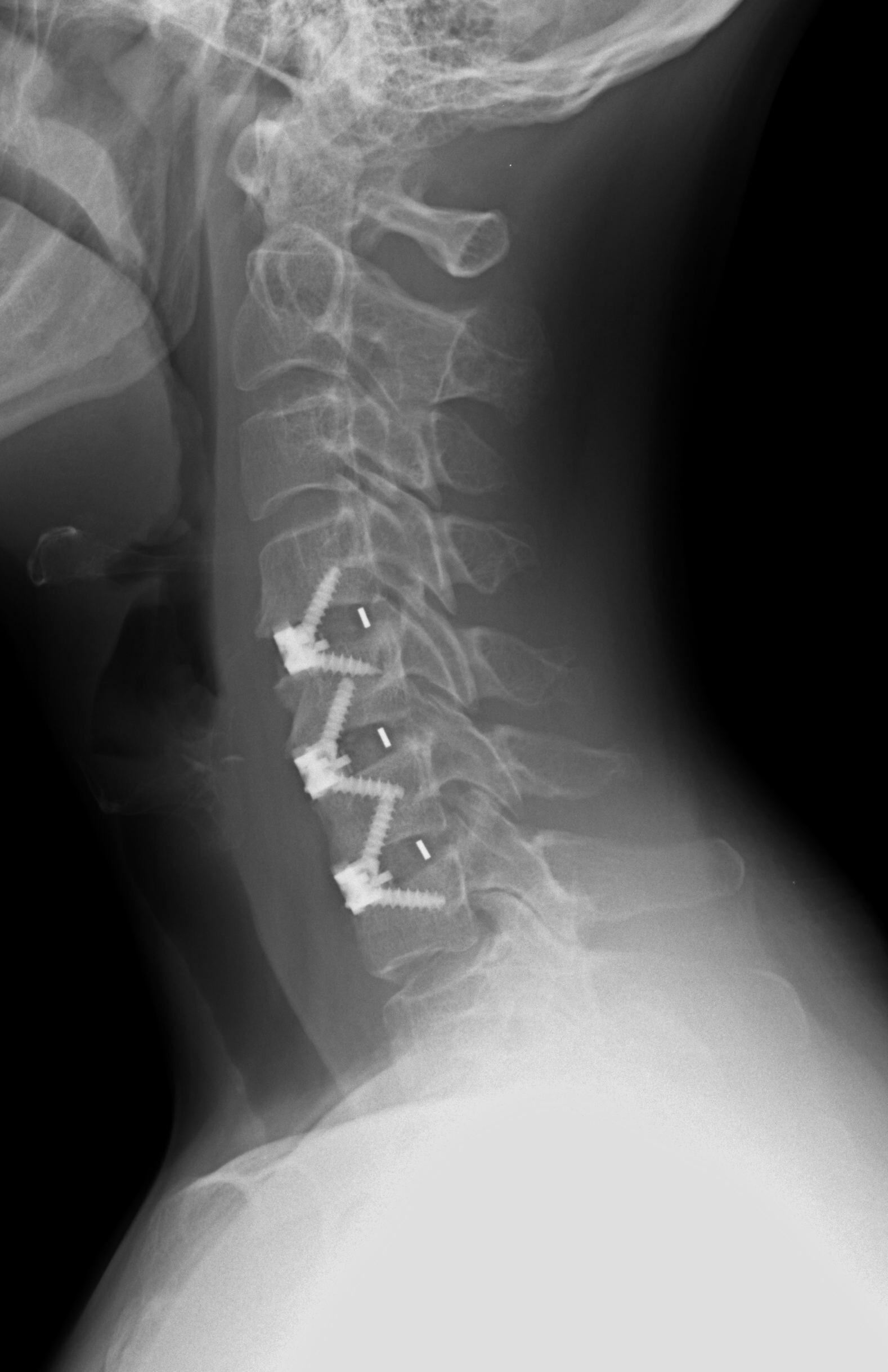 Decompression Anterior Cervical Decompression And Fusion